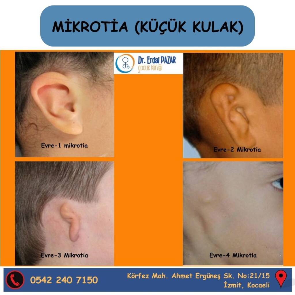 KONJENİTAL KULAK ANOMALİLERİNDEN BİRİ - MİKROTİA (KÜÇÜK KULAK) - Uzm ...